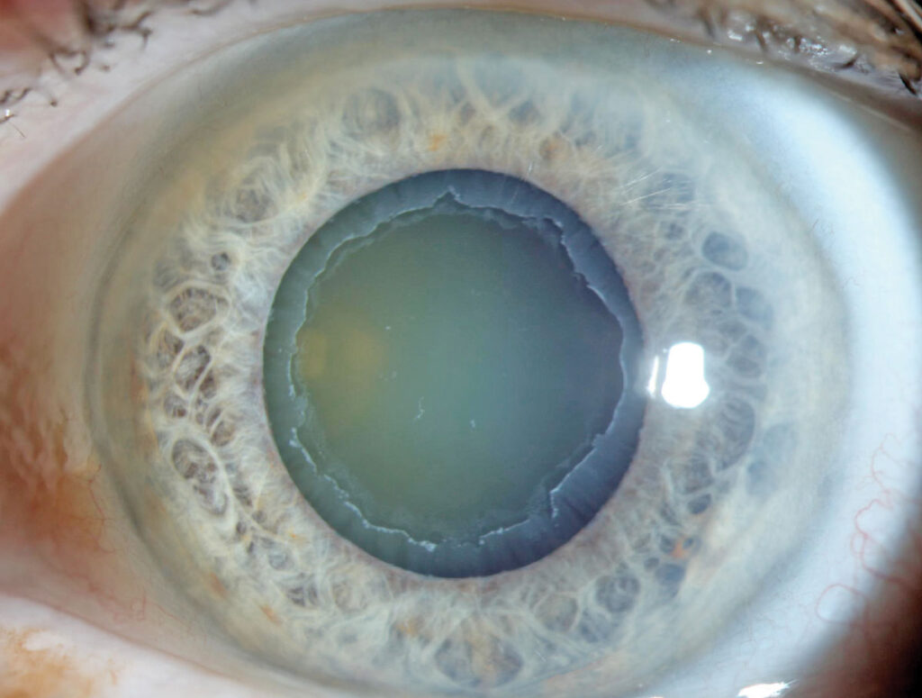 Cataract Surgery with Premium IOL - Akshar Eye Hospital